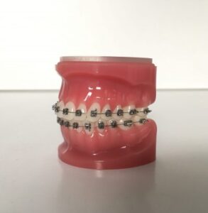 Soorten beugels - Orthodontistenpraktijk Weert